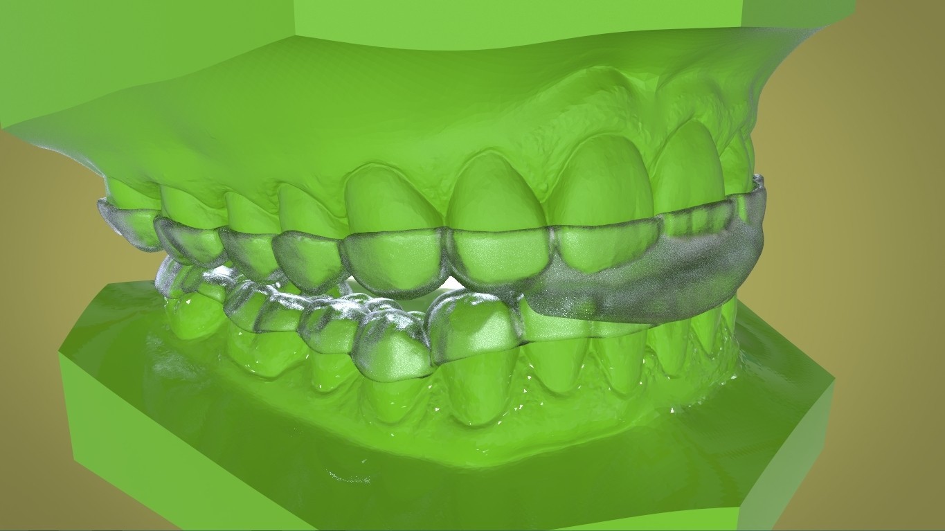 STL file Digital Dental B Splints 🦷 (OBJ)・3D printing model to download ...