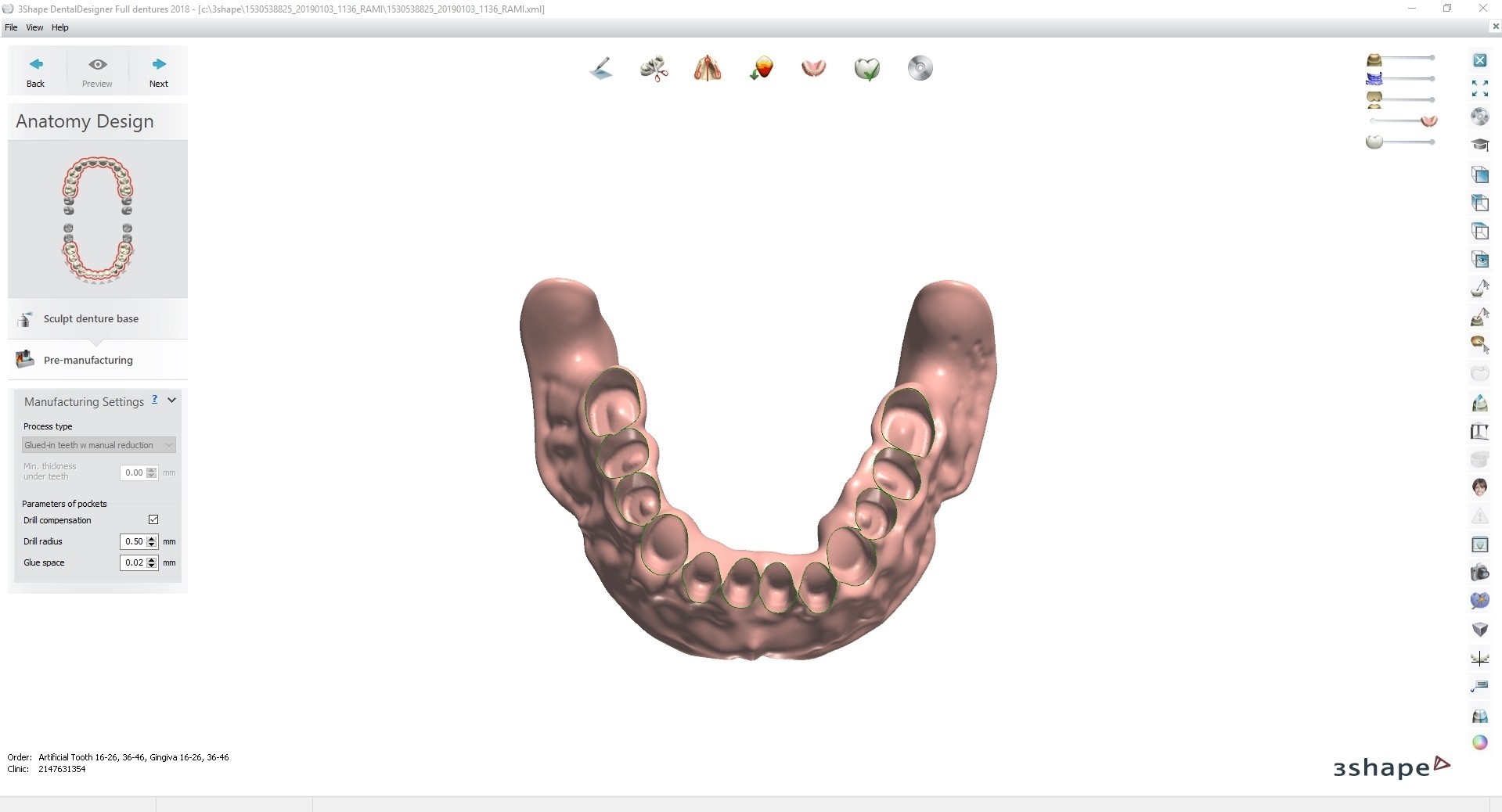 STL file Digital Full Dentures for Gluedin Teeth with Manual Reduction ...