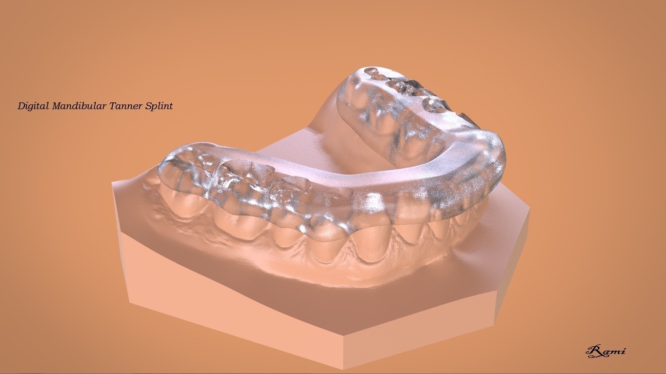 STL file Digital Mandibular Tanner Splint 🦷・3D printer model to ...