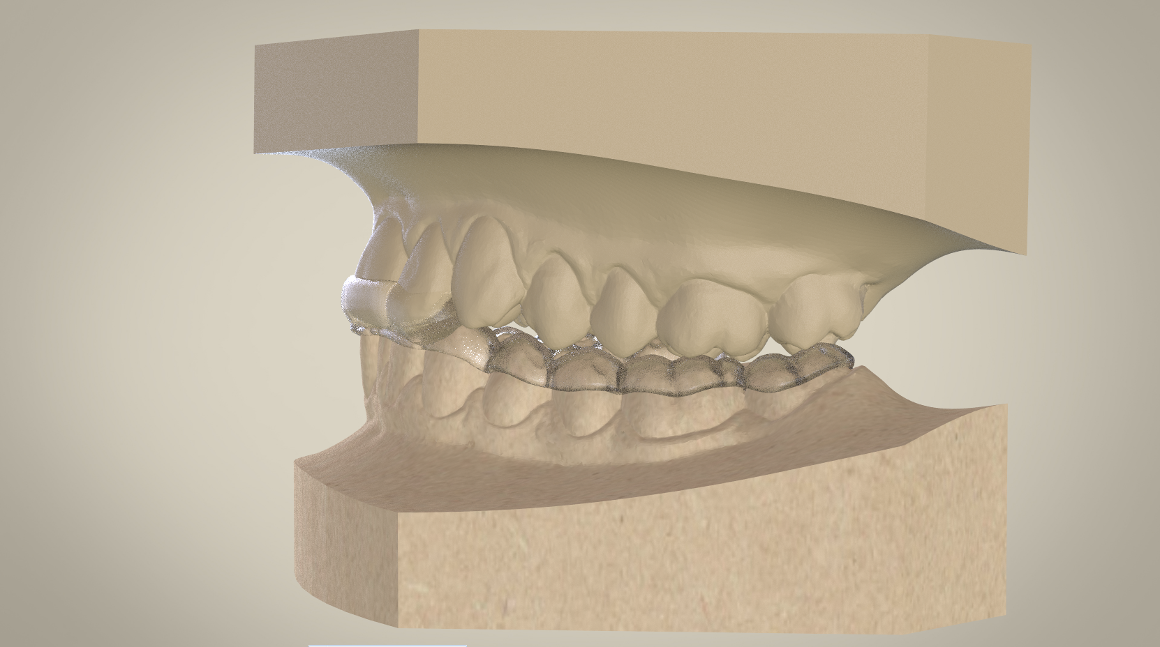 STL file Ortho Superior Repositioner Splint 💤 (OBJ and 3MF)・3D ...