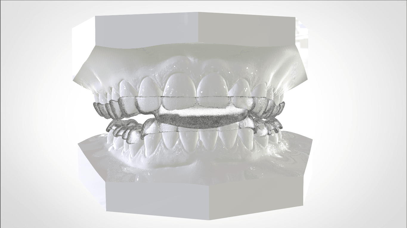 STL file Digital Dental B Splints 💤 (OBJ and 3MF)・3D printing model to ...