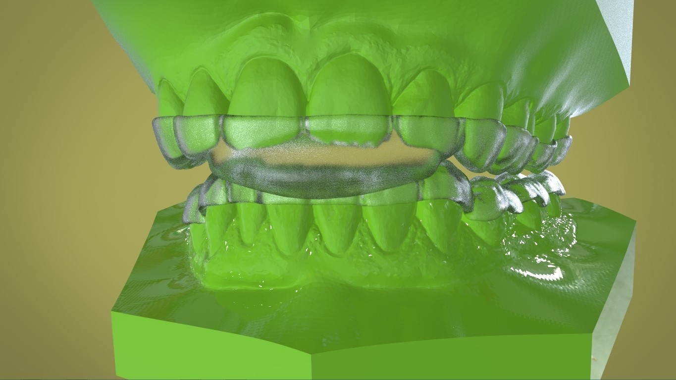 STL file Digital Dental B Splints 🦷 (OBJ)・3D printing model to download ...