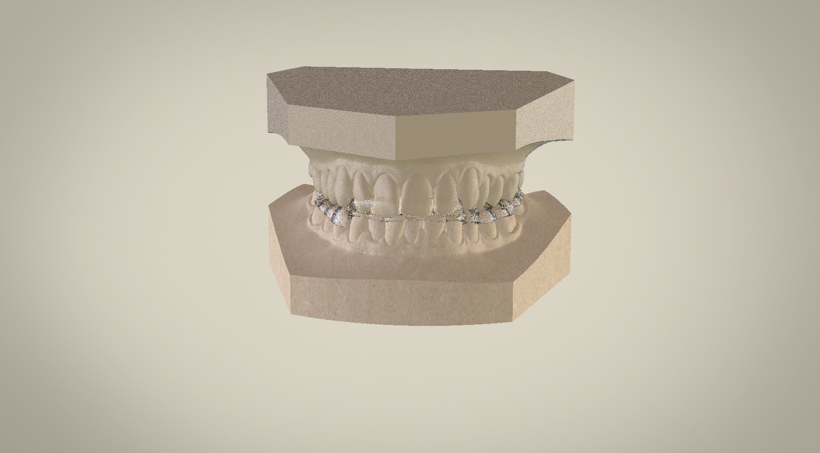 STL file Ortho Superior Repositioner Splint 💤 (OBJ and 3MF)・3D ...