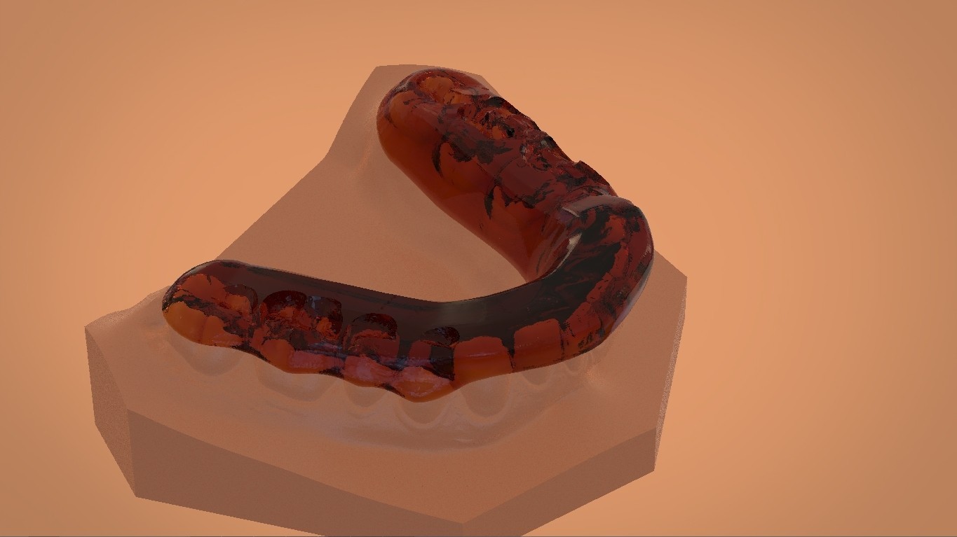 STL file Digital Mandibular Tanner Splint 🦷・3D printer model to download・Cults