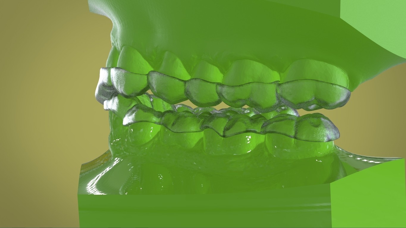 STL file Digital Dental B Splints 🦷 (OBJ)・3D printing model to download ...