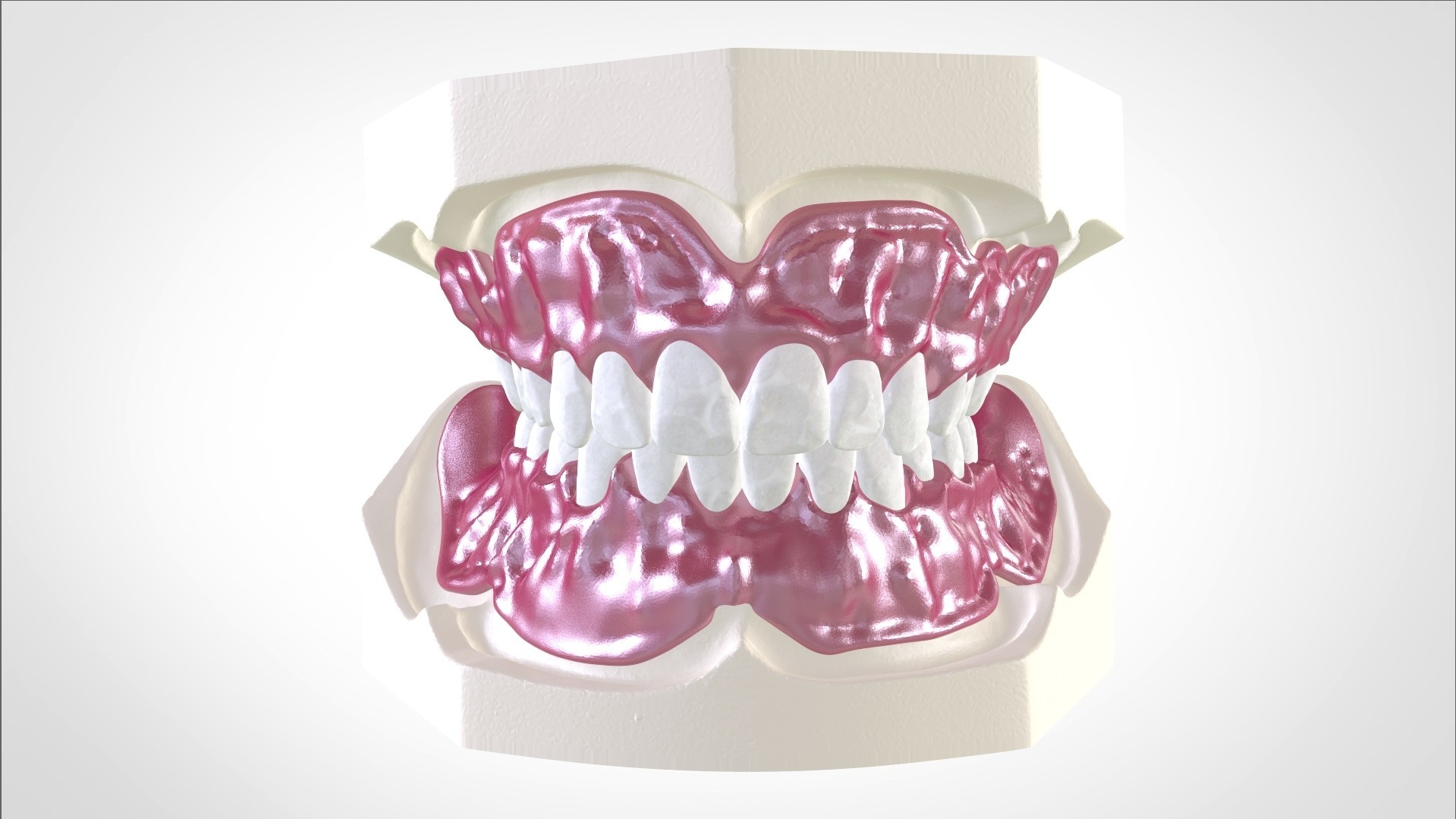 STL file Digital Full Dentures for Gluedin Teeth with Manual Reduction ...