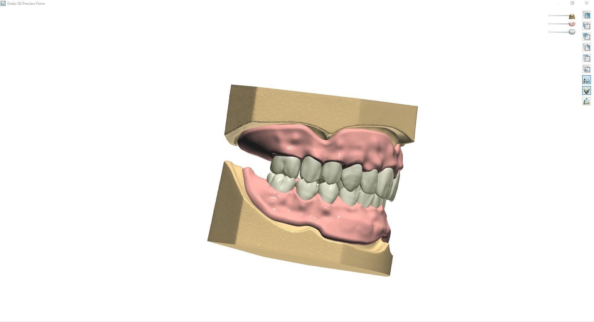 STL file Digital Full Dentures 🦷 ・3D printer model to download・Cults