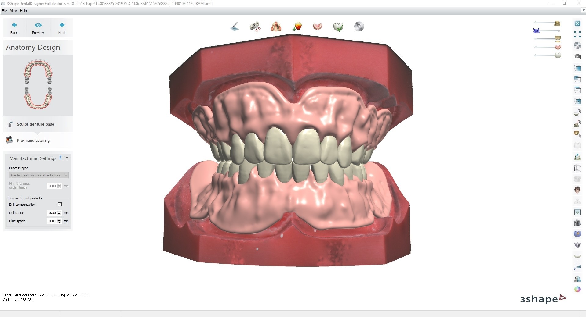 STL file Digital Full Dentures for Gluedin Teeth with Manual Reduction ...