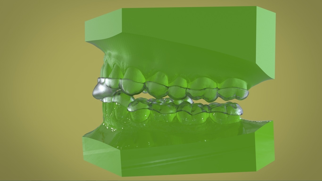 STL file Digital Dental B Splints 💤 (OBJ and 3MF)・3D printing model to ...