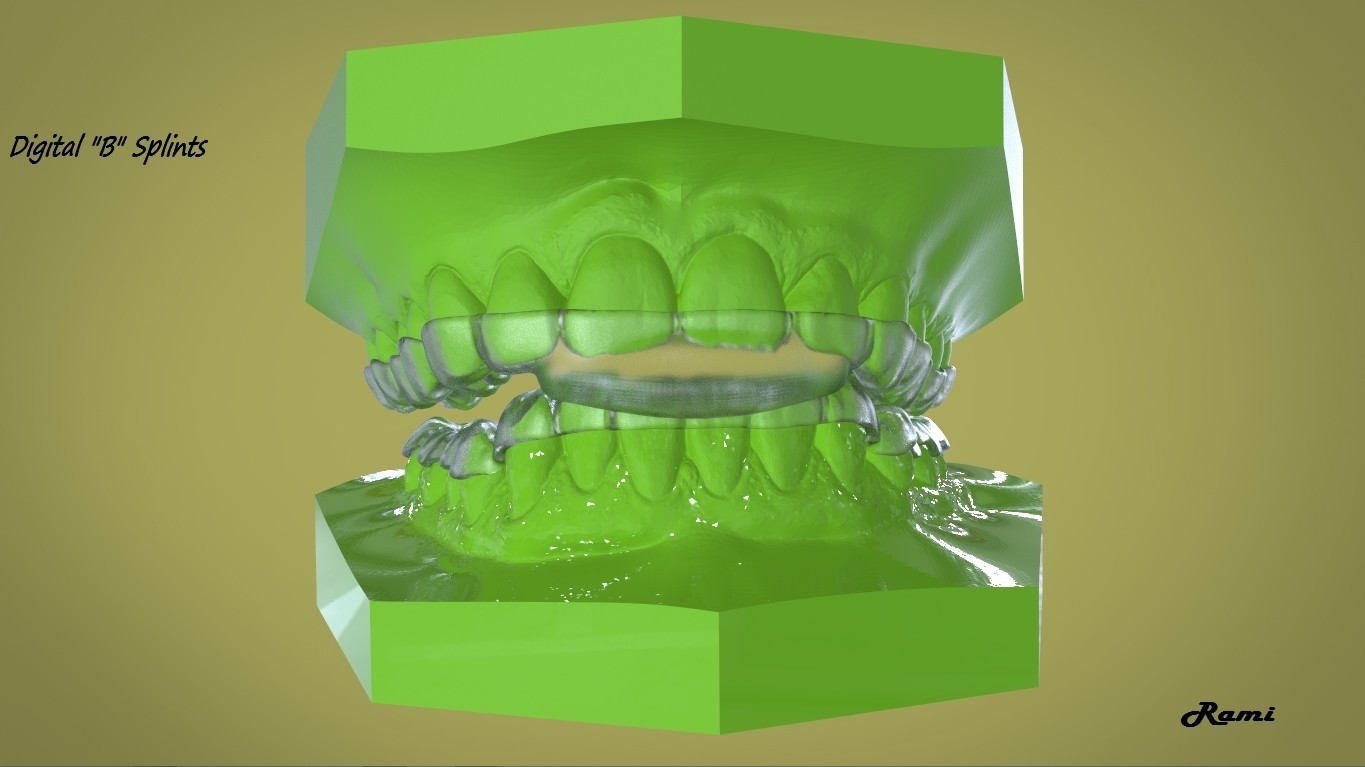 STL file Digital Dental B Splints 💤 (OBJ and 3MF)・3D printing model to ...