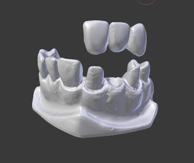STL file Dental model prosthesis 🦷 ・Design to download and 3D print・Cults