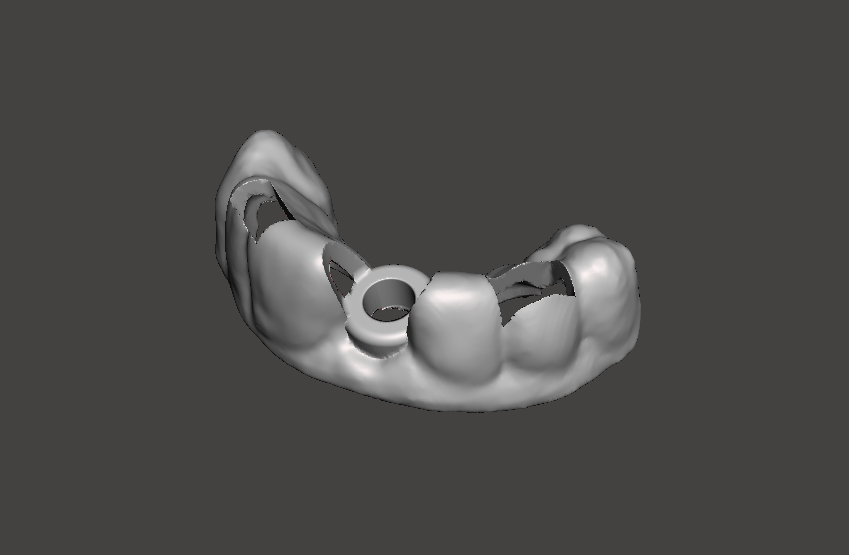 STL file SURGICAL SPLINT FOR GUIDED SURGERY 🎨・3D printable model to ...