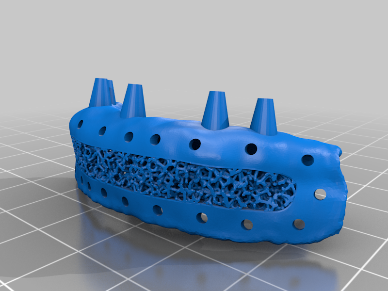 Free STL file IMPLANT 🦷 ・3D printing model to download・Cults