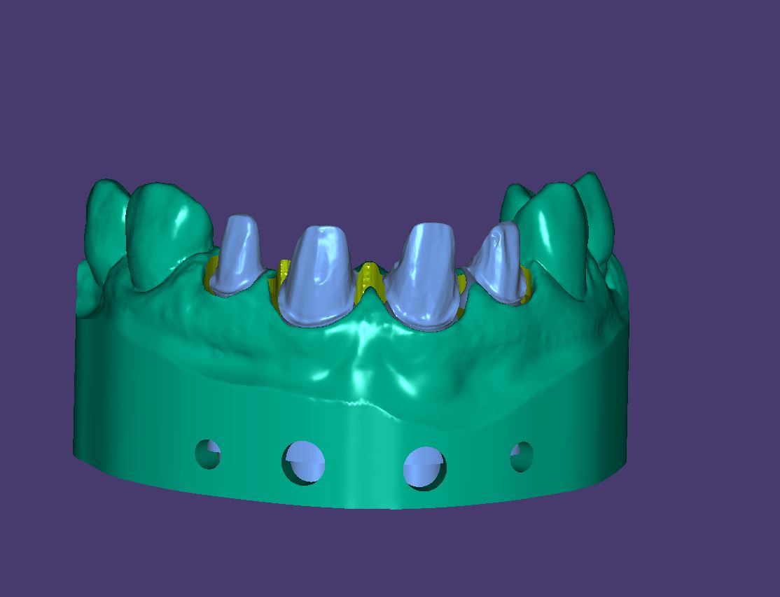 STL file Dental Model with anterior removable Dies and Bridge Coping 🌉 ...