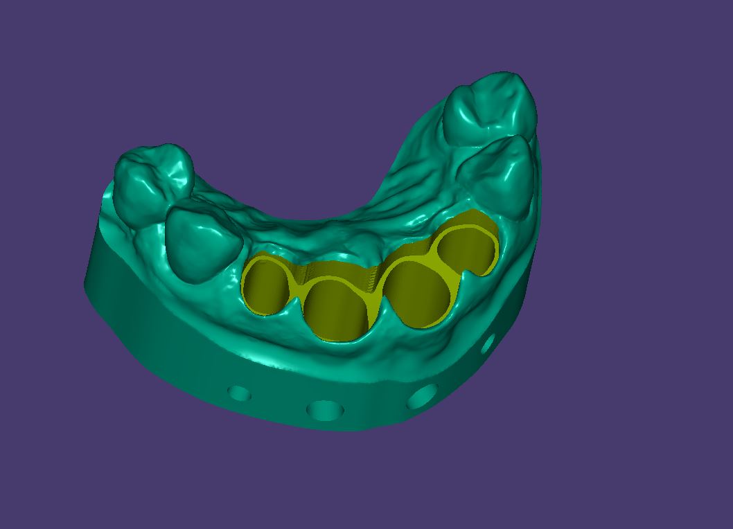 STL file Dental Model with anterior removable Dies and Bridge Coping 🌉 ...