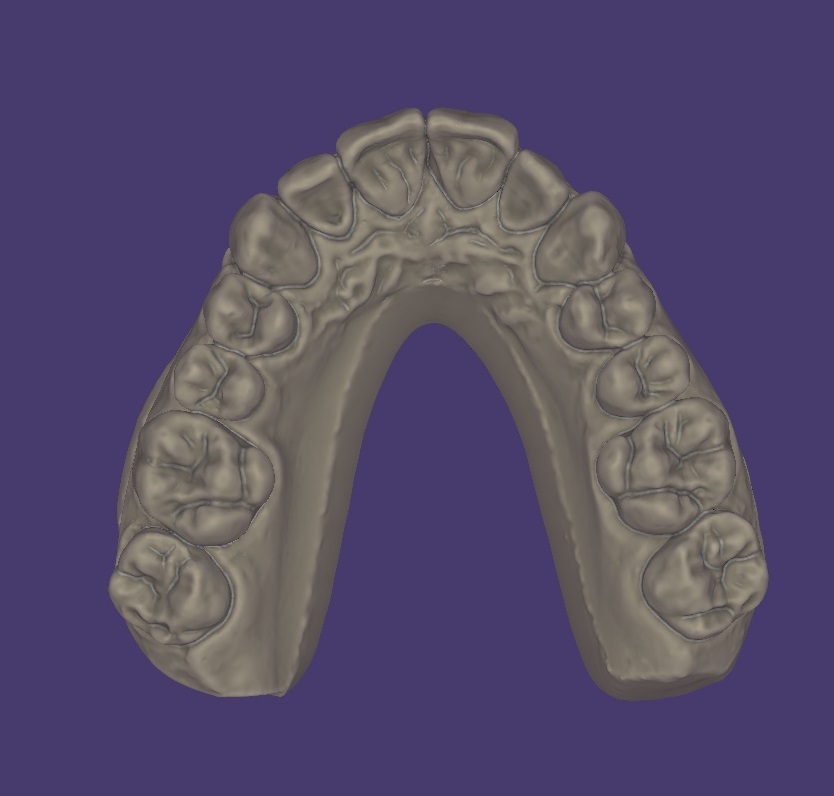 STL file UPPER DENTAL MODEL + BITE SPLINT, UPPER MODEL PLUS REST PLATE ...