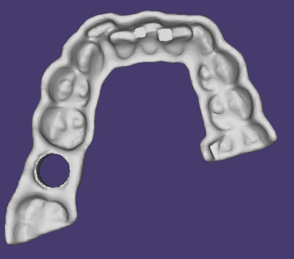 👽 SURGICAL GUIDE・ STL File for 3D printing・Cults