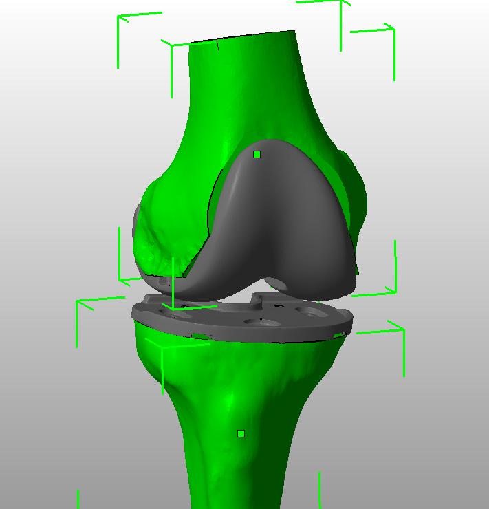 STL file Knee joint prosthesis with guides (sample of individual ...