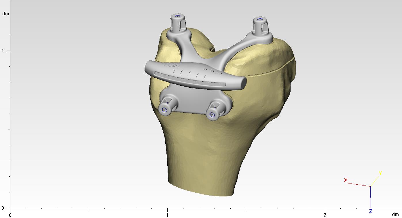 STL file Knee joint prosthesis with guides (sample of individual ...