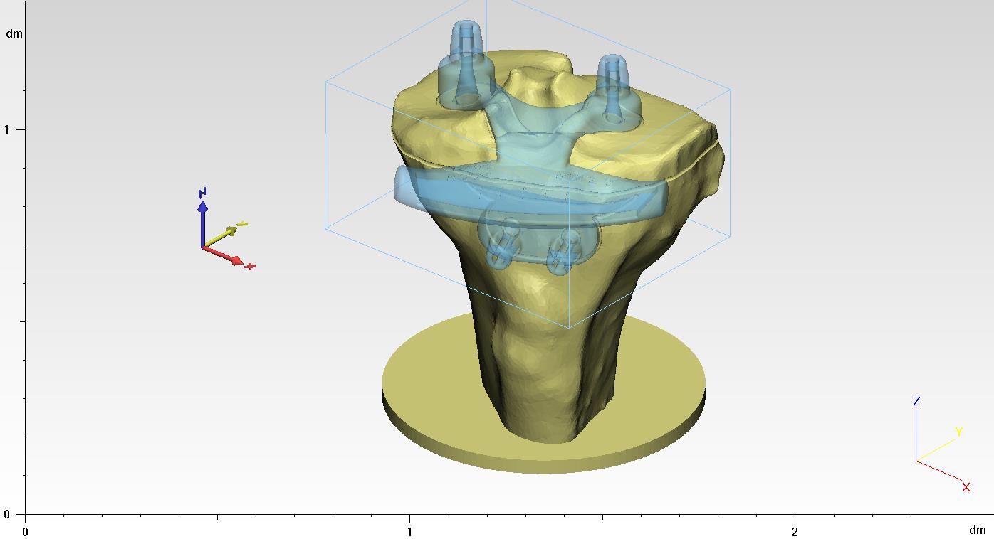 STL file Knee joint prosthesis with guides (sample of individual ...