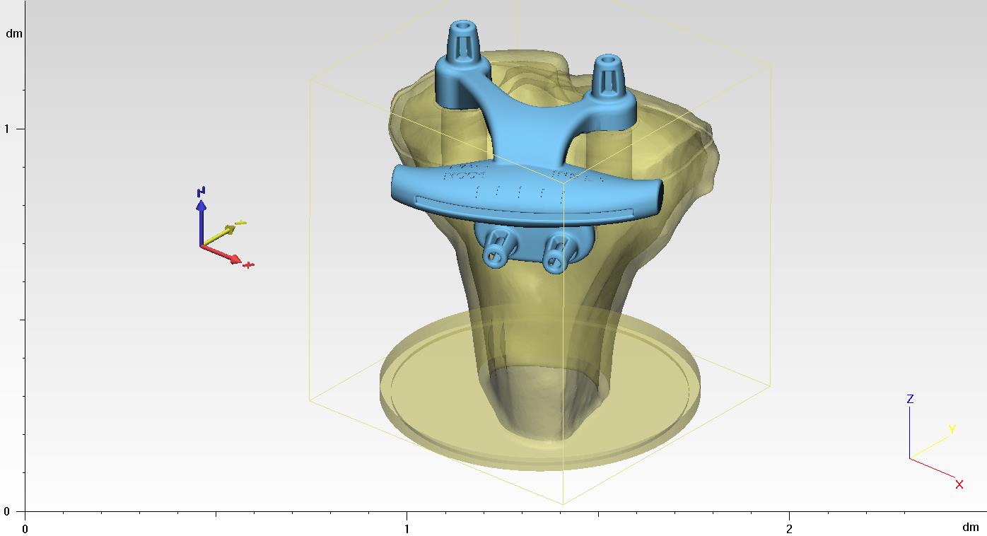 STL file Knee joint prosthesis with guides (sample of individual ...